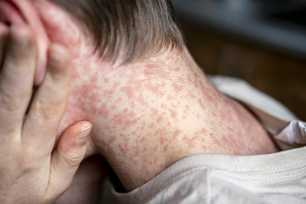 Measles Risk - Check Your Vaccinations Now - Tasmanian Times